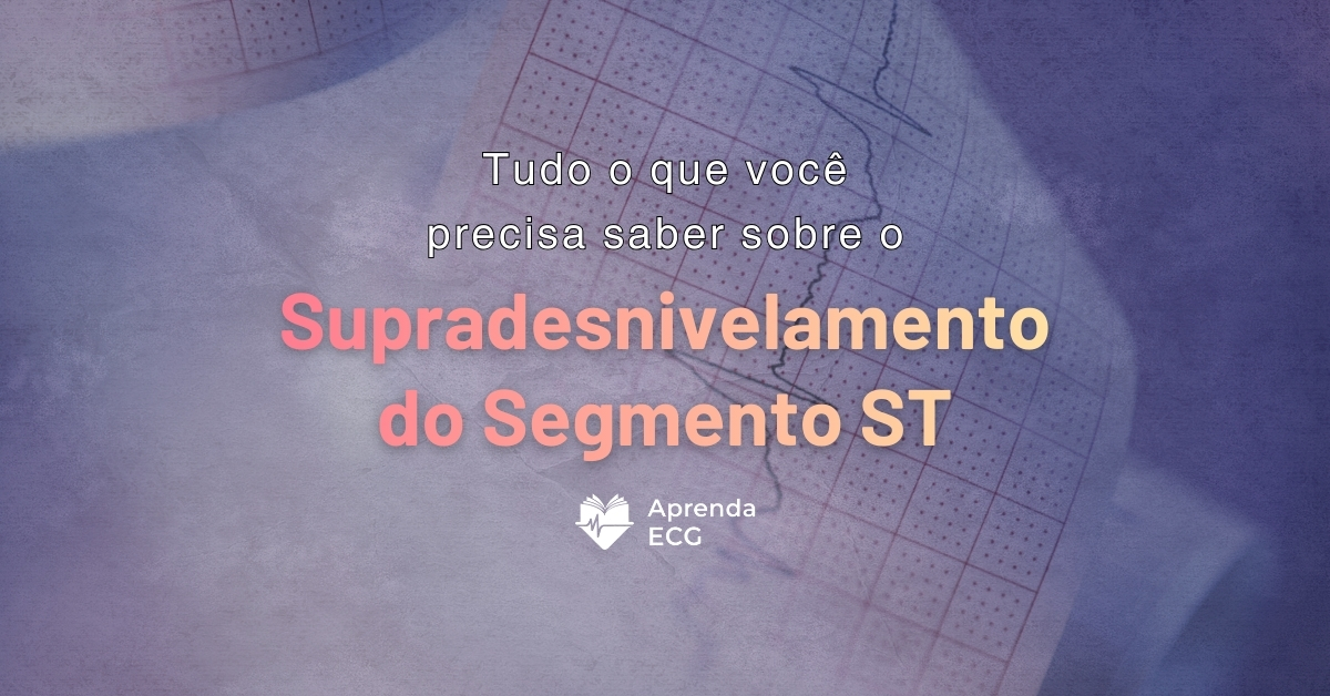 Tudo que Você Precisa Saber sobre o Supradesnivelamento do Segmento ST ...