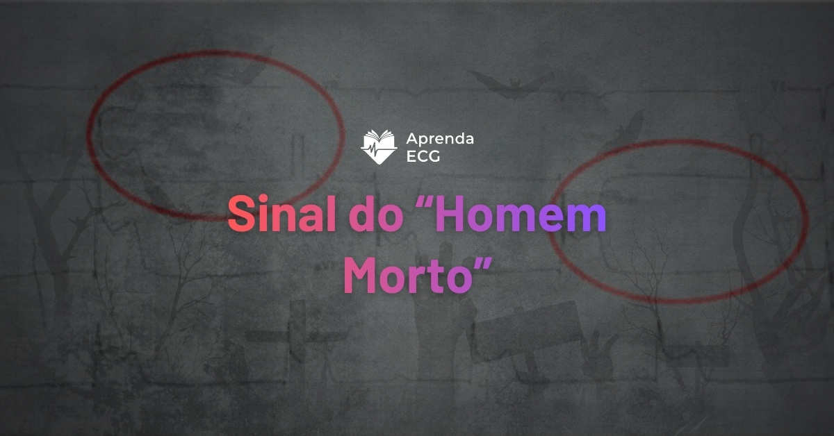Sinal do Homem Morto no ECG: curiosidade visual no IAM inferior ...